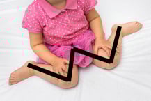 W Sitting: The What, Why, How to Intervene, and When to be Concerned?